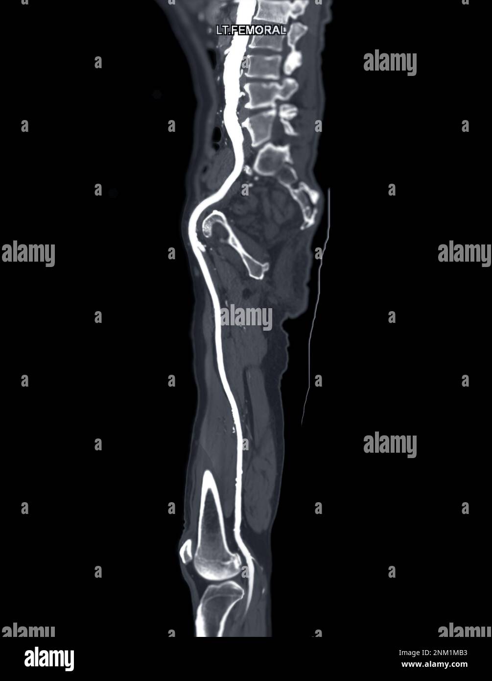 CTA femoral artery run off MPR curve showing Left femoral artery for ...