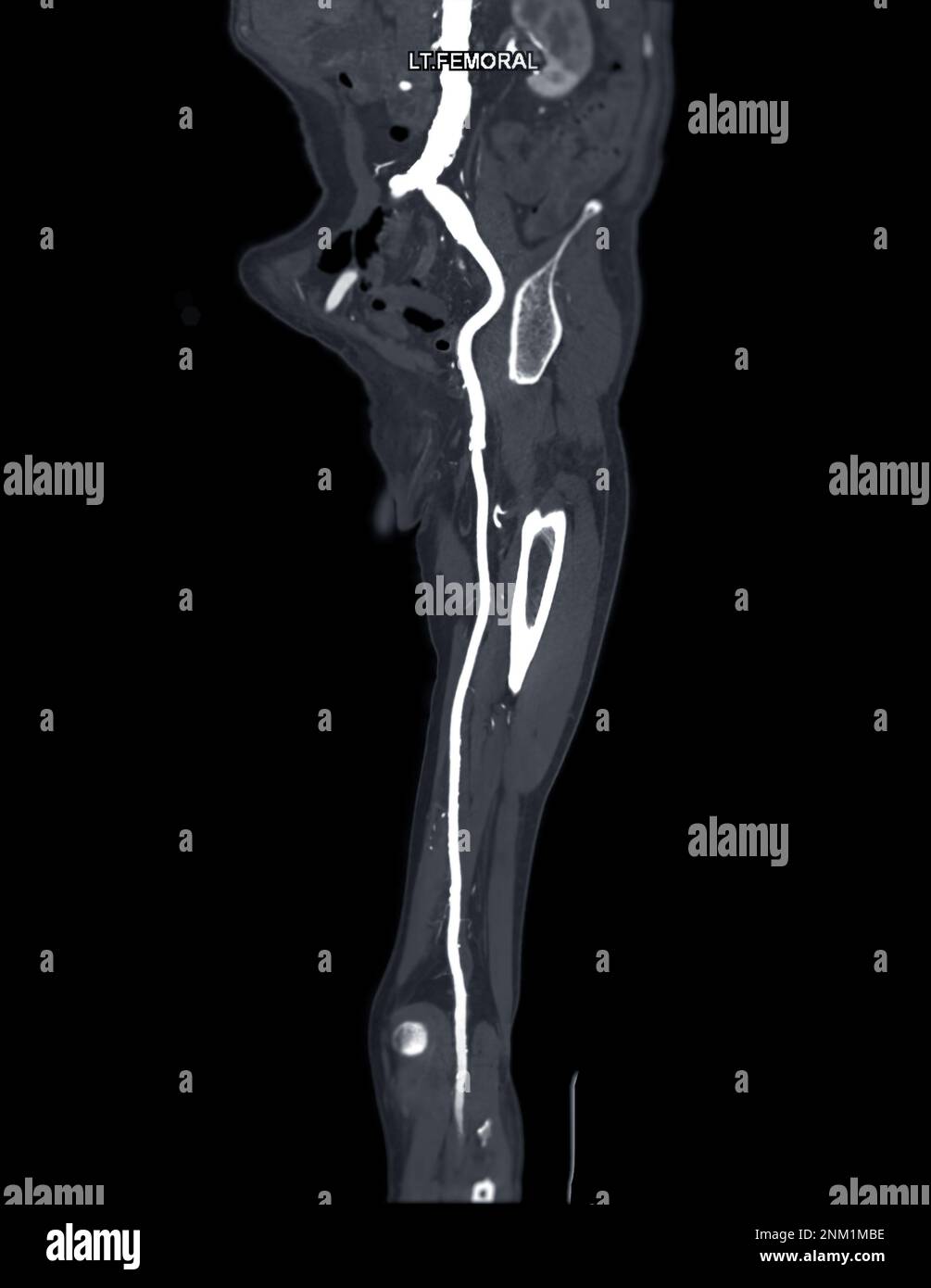 CTA femoral artery run off MPR curve showing Left femoral artery for ...