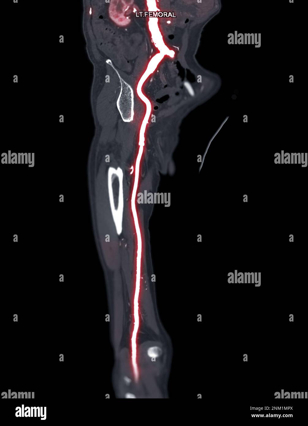 CTA femoral artery run off MPR curve showing Left femoral artery for ...