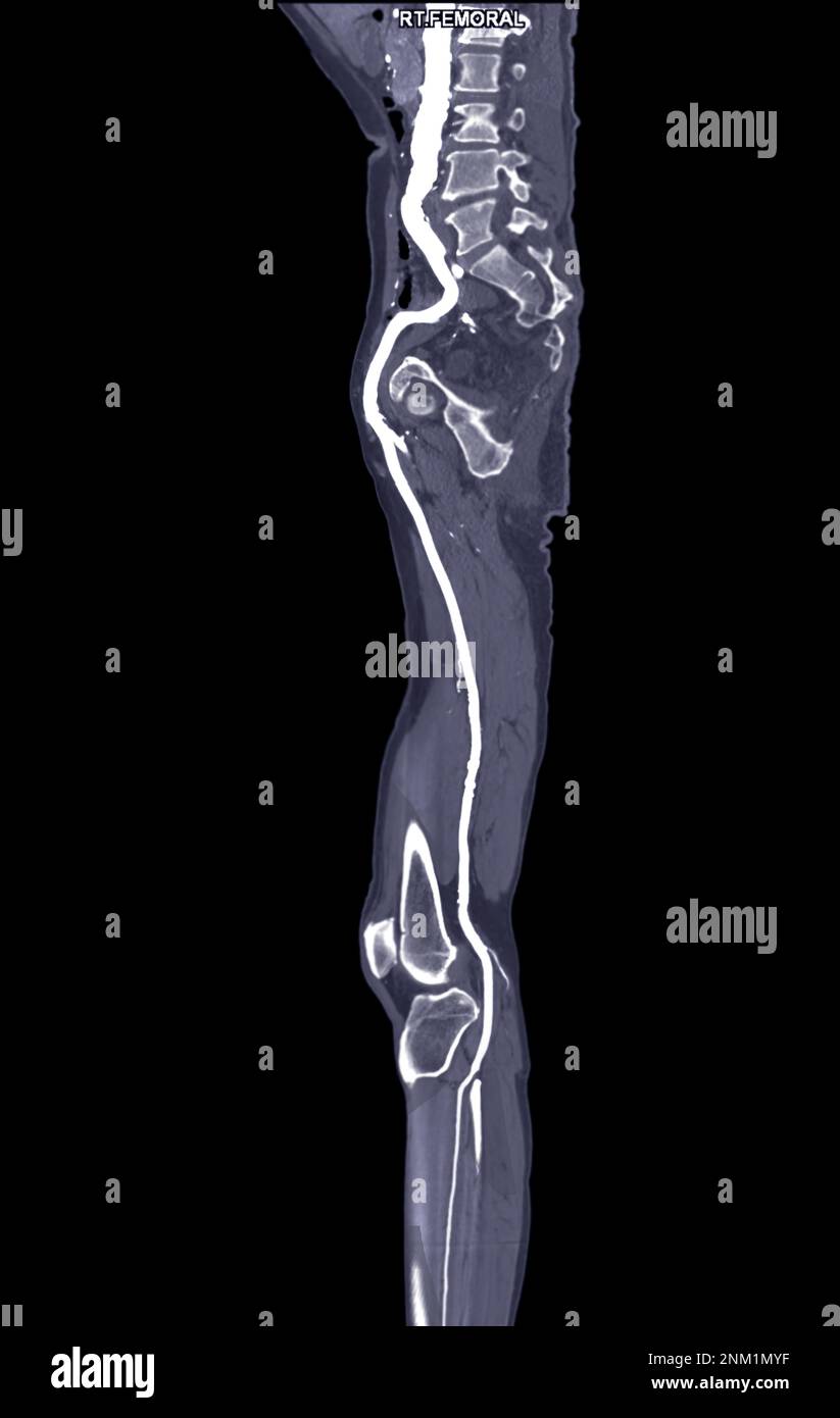 CTA femoral artery run off MPR curve showing Right femoral artery for ...