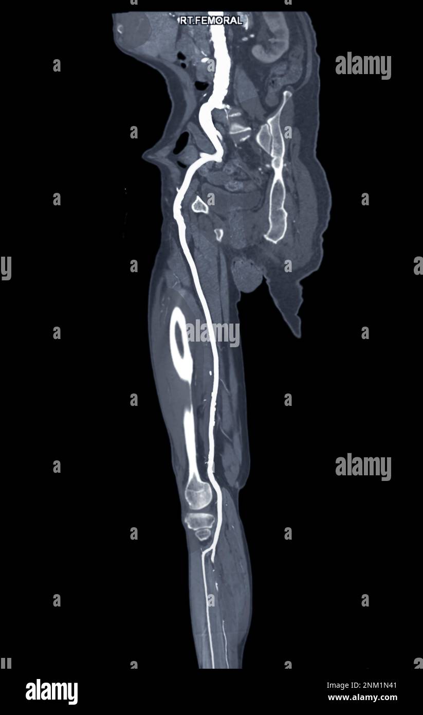 CTA femoral artery run off MPR curve showing Right femoral artery for ...