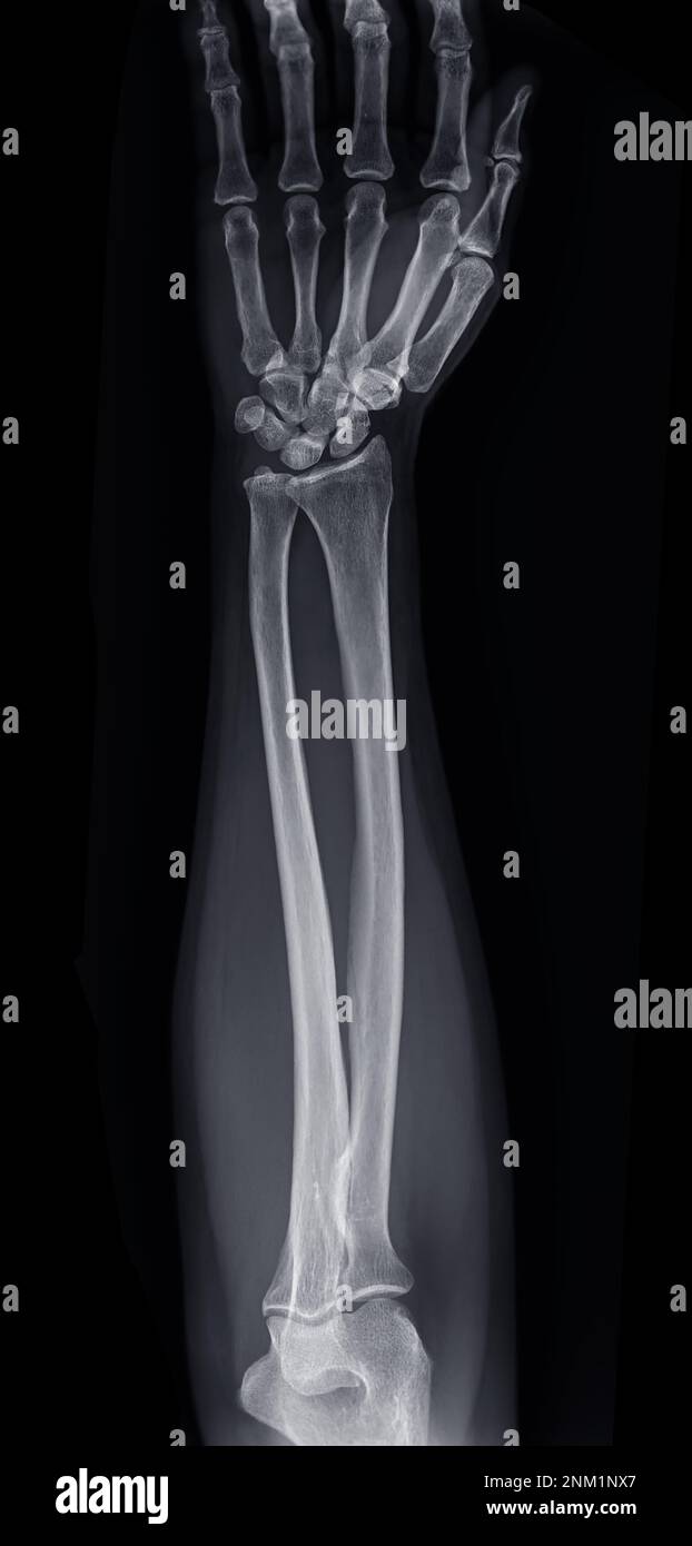 X-ray image of forearm bone Stock Photo - Alamy