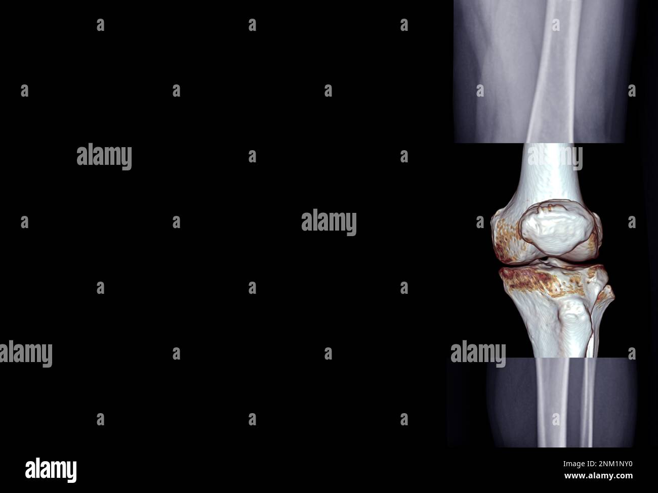 Film x-ray of knee joint AP view fusion with 3D rendering knee joint ...