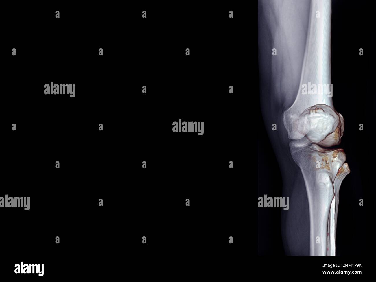 Film x-ray of knee joint AP view fusion with 3D rendering knee joint ...
