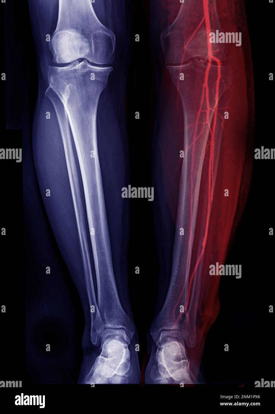 X-ray image of leg Fusion with CTA Femoral run off Stock Photo - Alamy