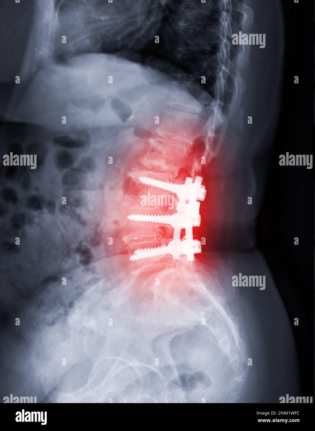 Spinal implant in lumbar hi-res stock photography and images - Alamy