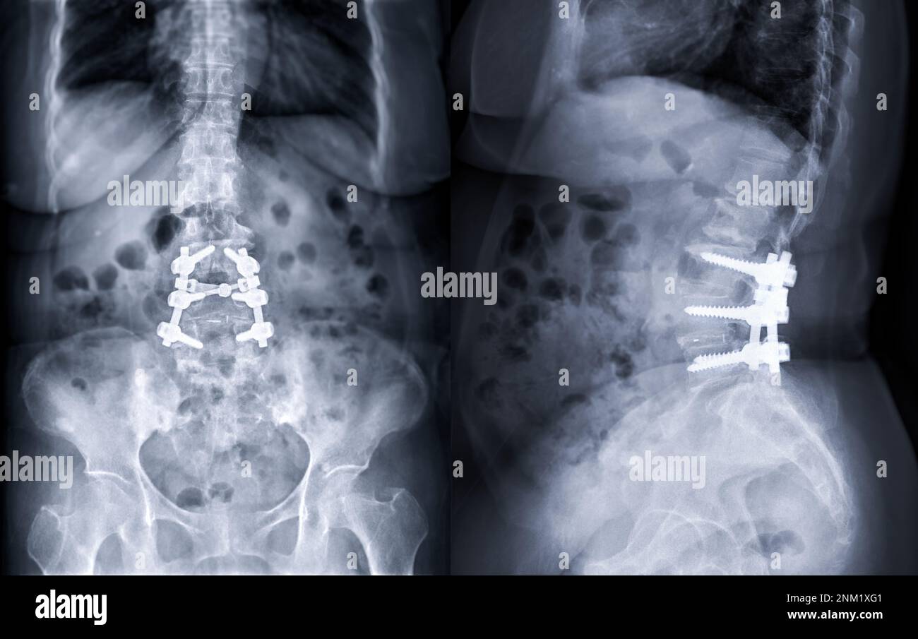 Spinal implant in lumbar hi-res stock photography and images - Alamy