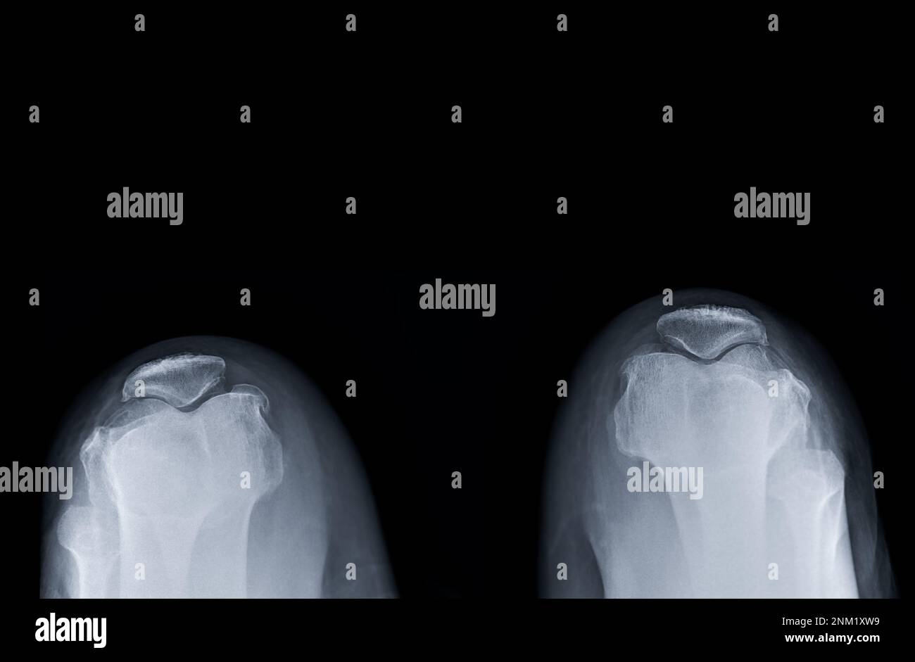 Normal knee x ray hi-res stock photography and images - Alamy