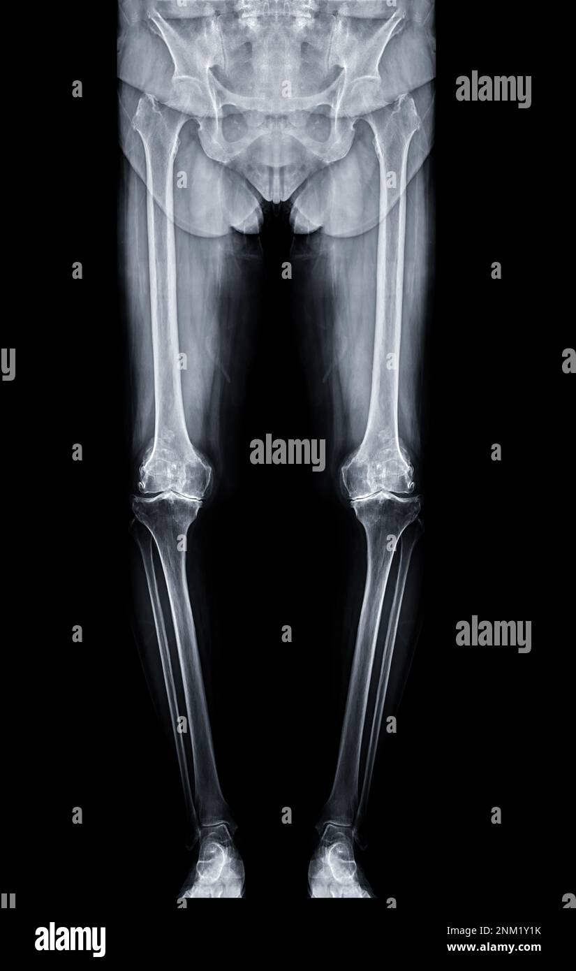 Scanogram is a Full-length standing AP radiograph of both lower ...