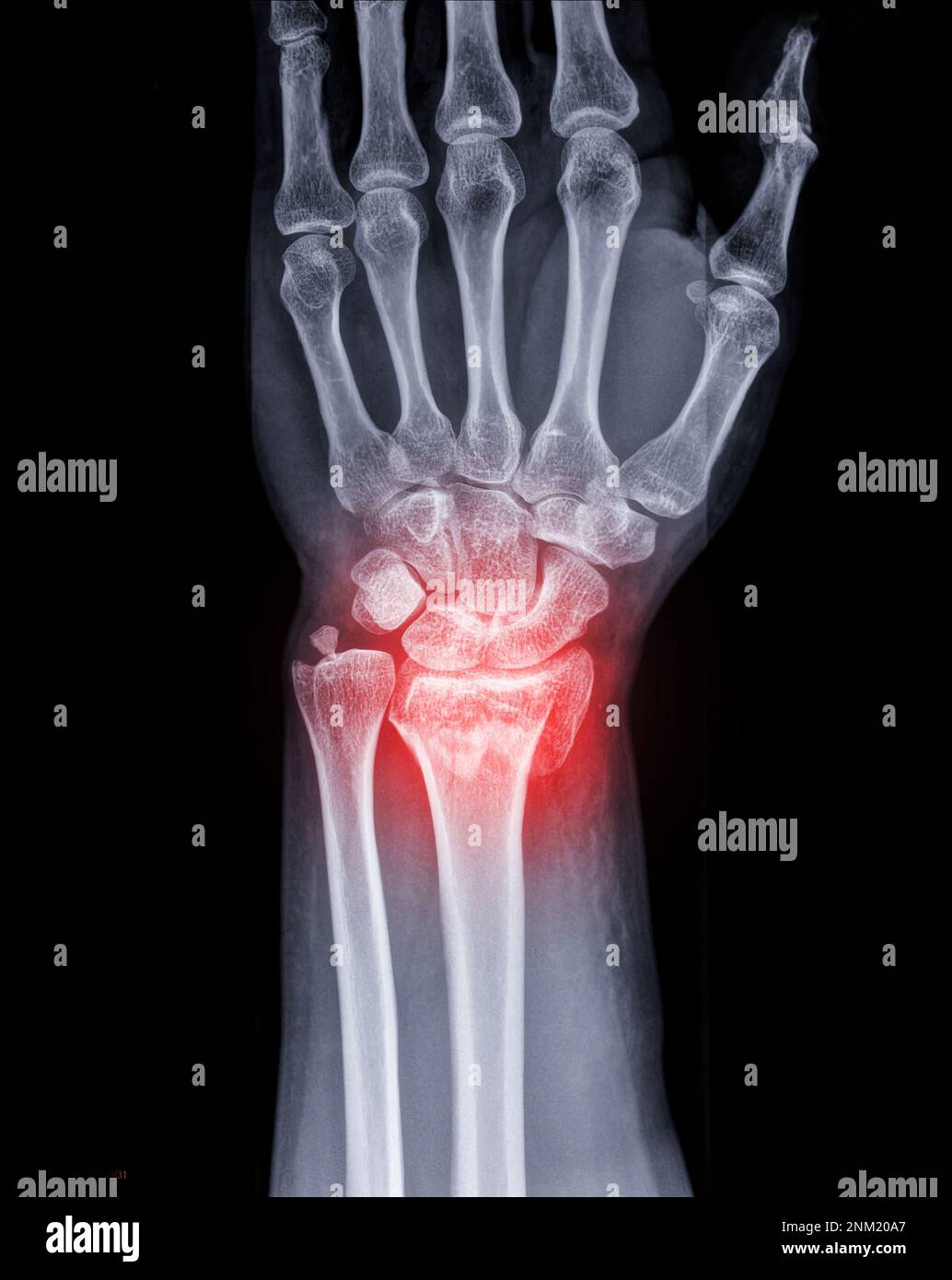 X Ray Image Of Left Wrist Joint Ap And Lateral View For Showing Fracture Of Radius Bone Stock