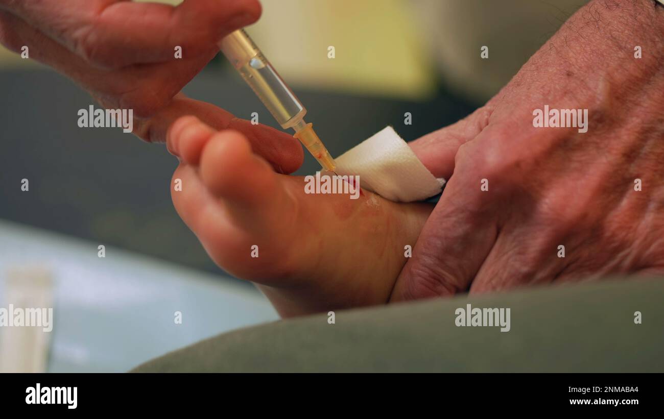Doctor hand closeup applying local anesthesia with syringe on child ...