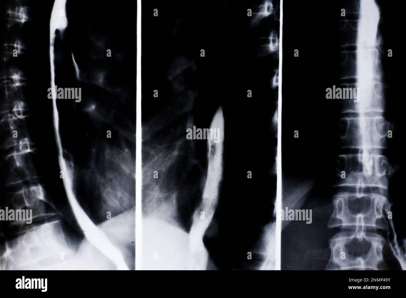 X-ray radiography of the spine with vertebrae Stock Photo - Alamy