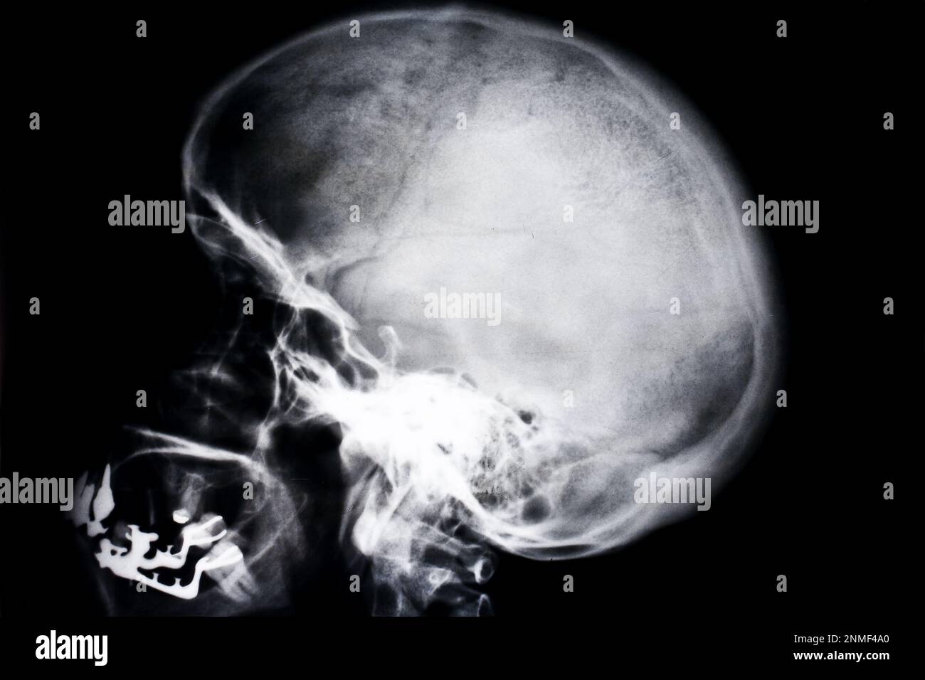 X-ray radiograph of the skull including the mouth Stock Photo - Alamy