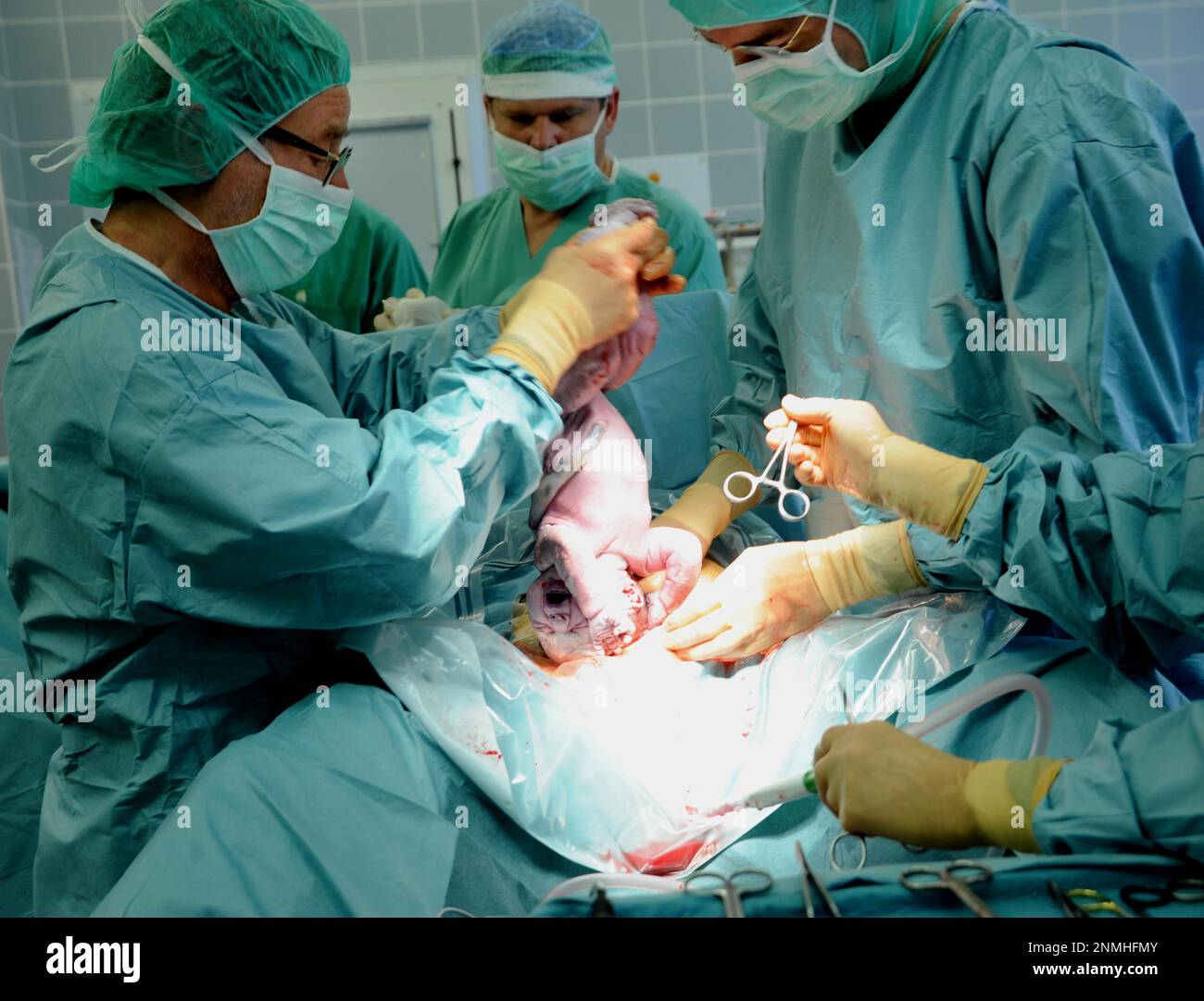 Breech Cesarean Section