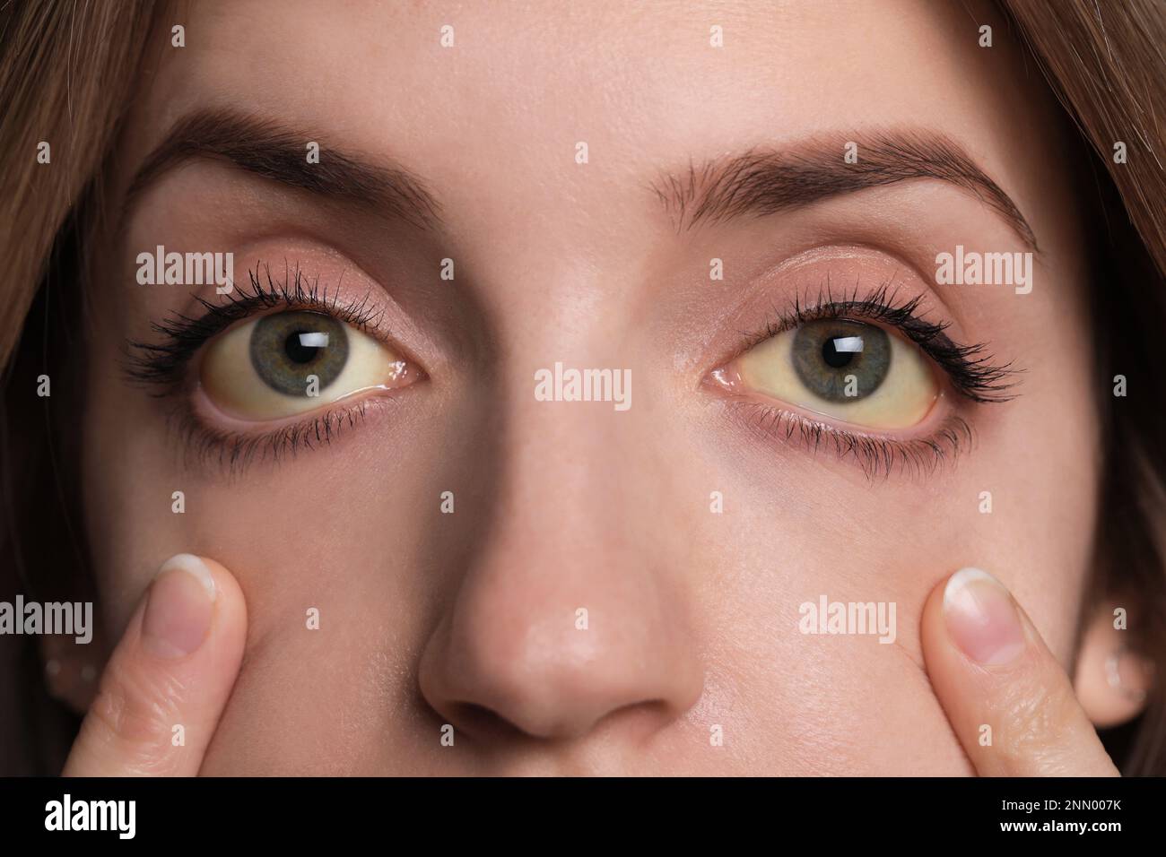 Woman checking her health condition, closeup. Yellow eyes as symptom of ...