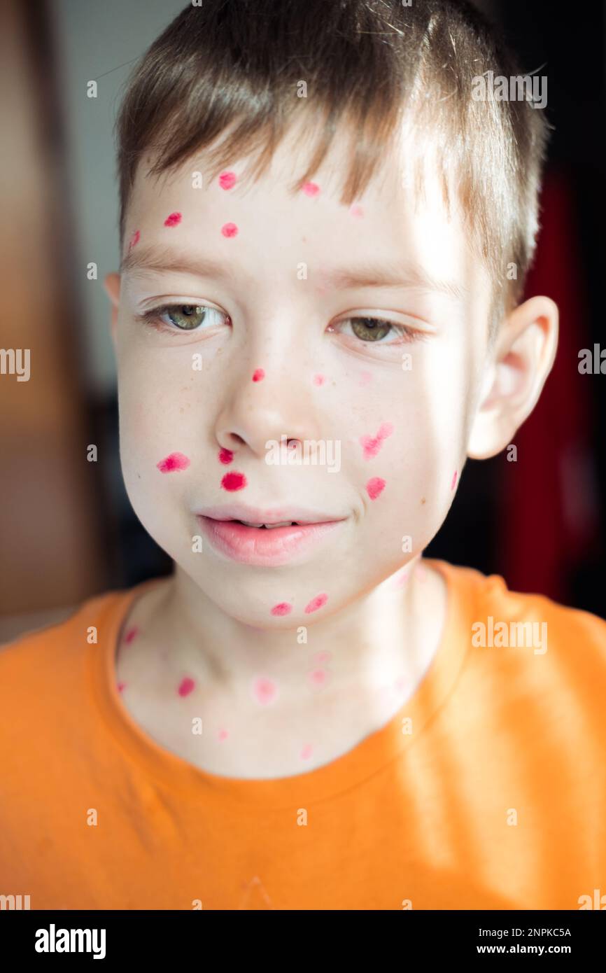 Portrait Of A 10 year old Boy With Chickenpox And A Rash On His Face portrait-of-a-10-year-old-boy-with-chickenpox-and-a-rash-on-his-face