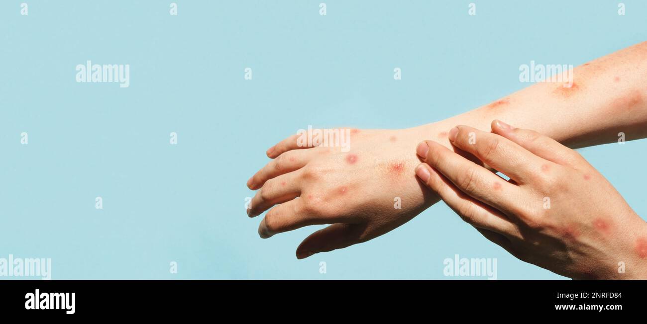 Monkeypox new disease dangerous over the world. Patient with Monkey Pox ...