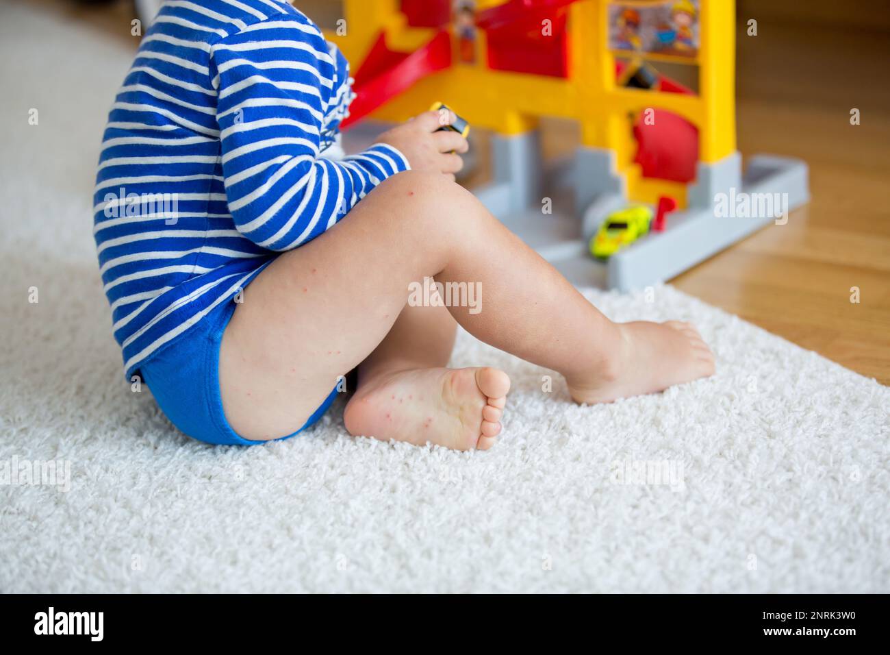 Hand foot and mouth disease in toddler child, boy Stock Photo - Alamy