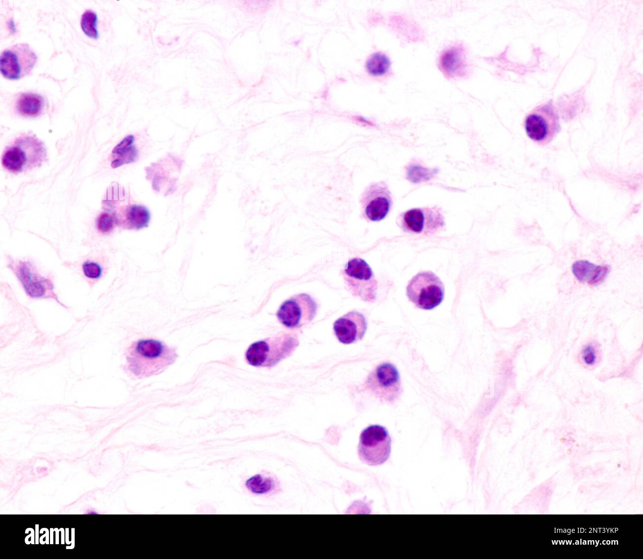 Plasma Cell Vs Lymphocyte
