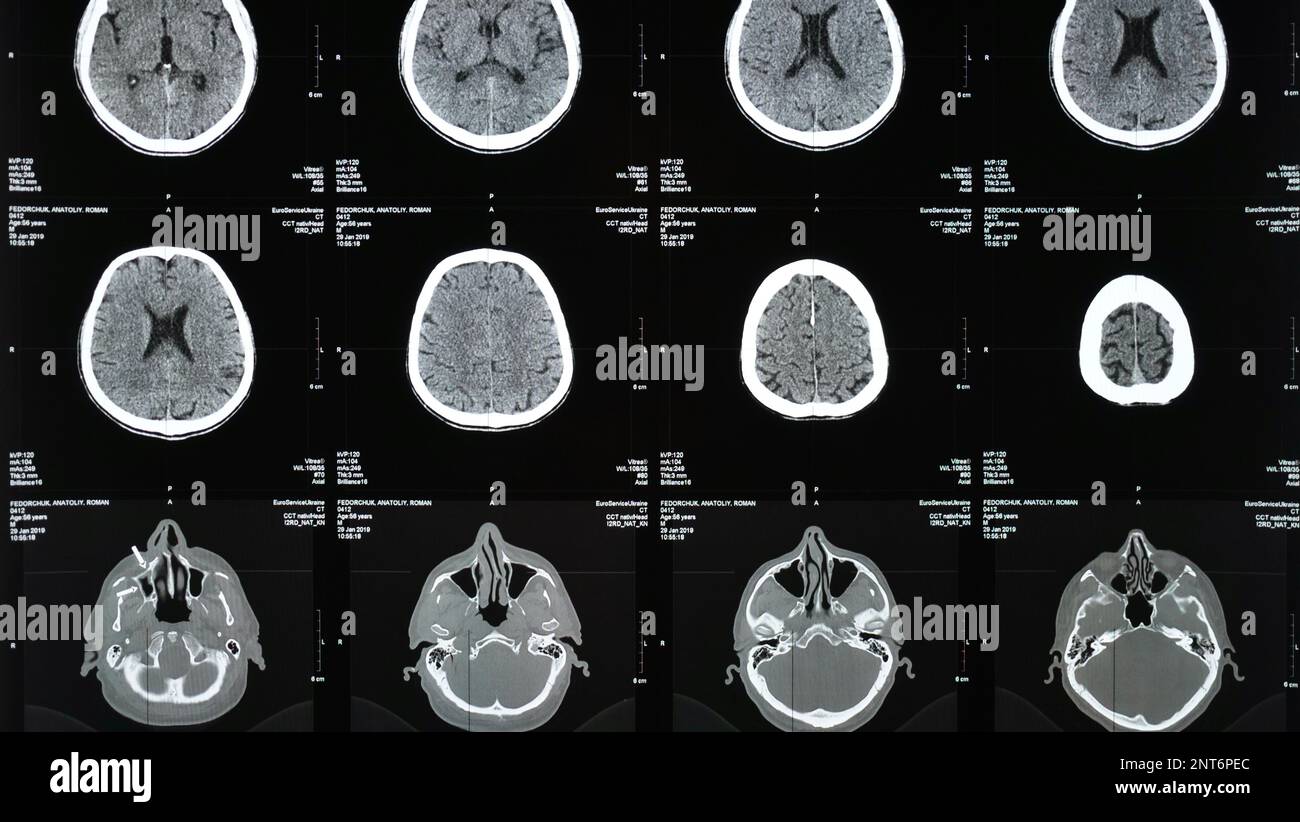 Magnetic resonance imaging of the brain from different sides, traumatic ...