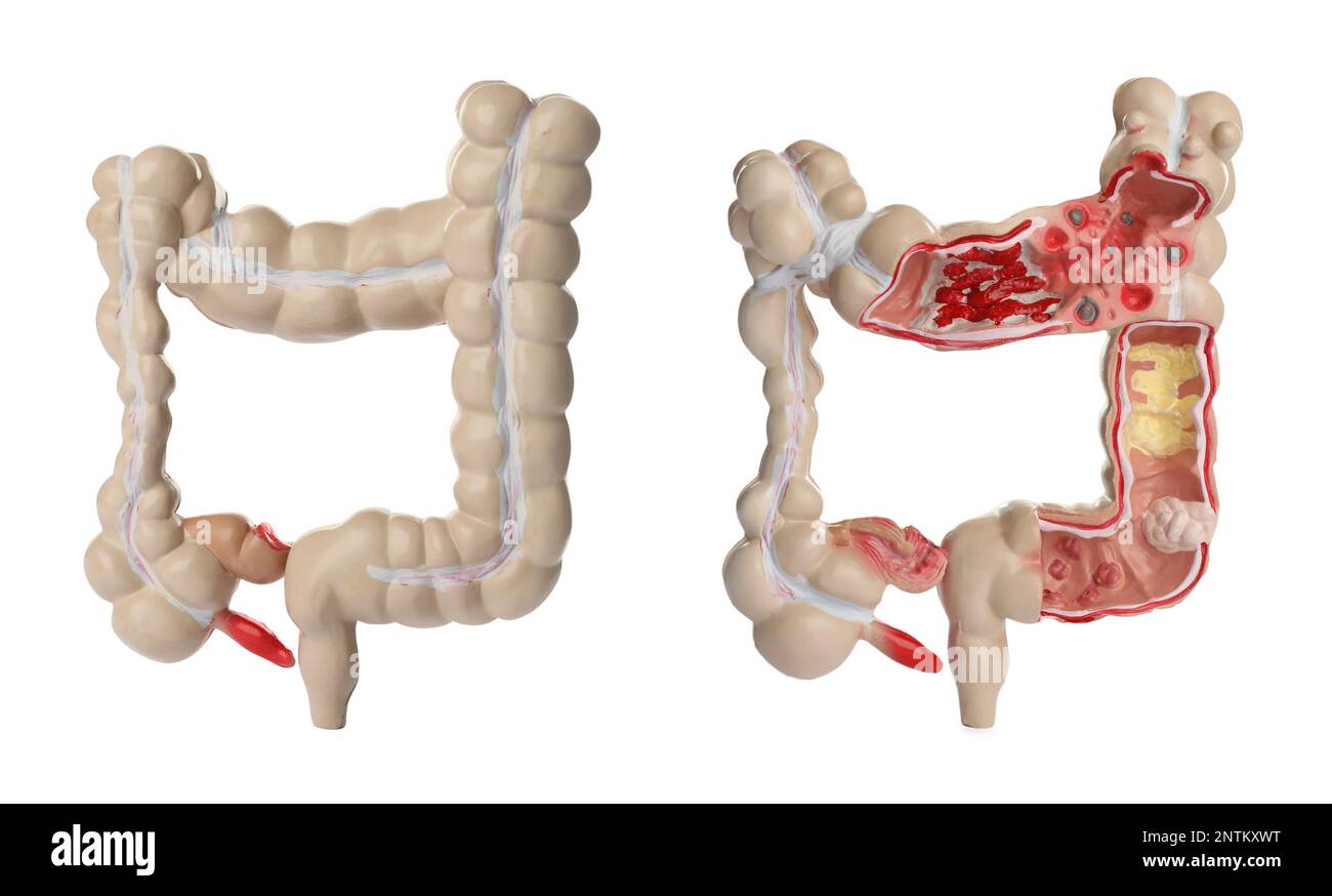 Anatomical model of large intestine on white background, collage ...