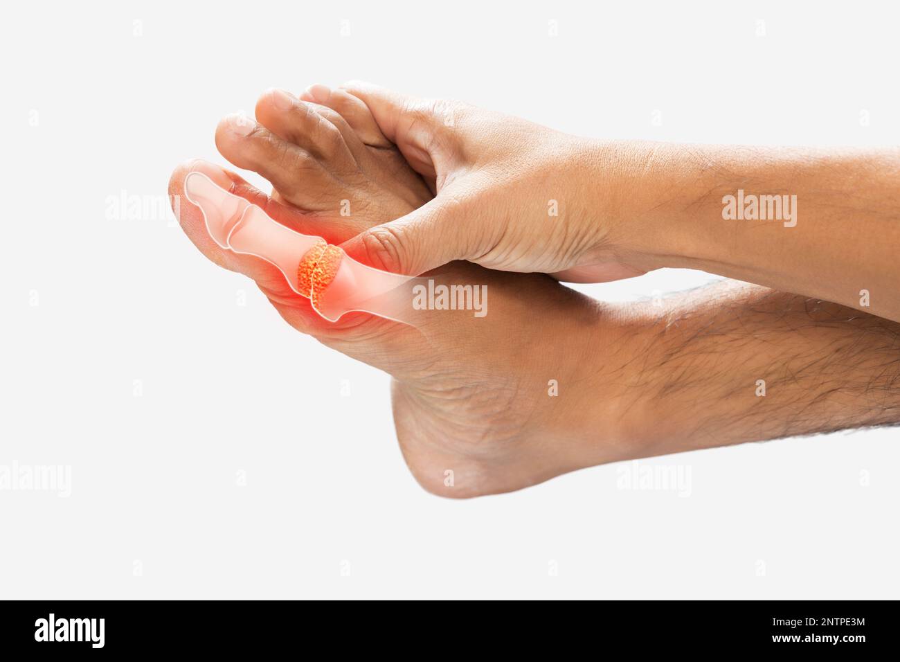 High levels of uric acid in men's toes bones on a gray background Stock ...