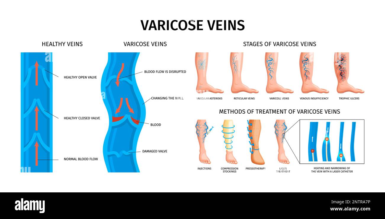 Varicose veins realistic infographics vector illustration with stages ...