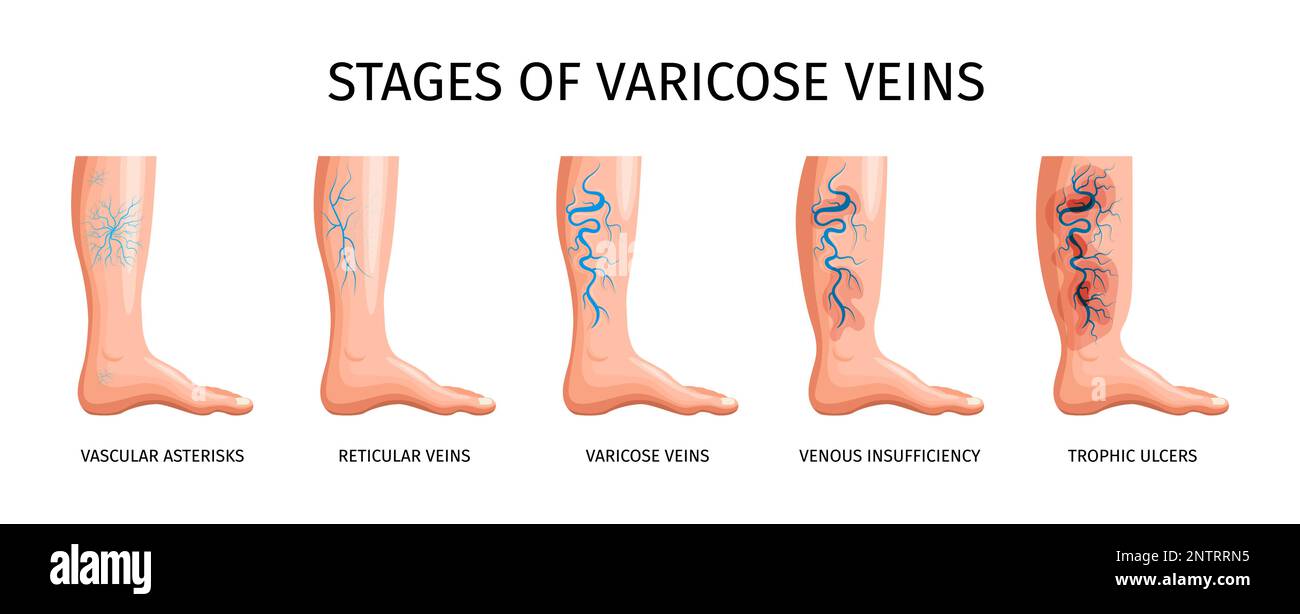 Stages of varicose veins so as vascular asterisks reticular veins ...