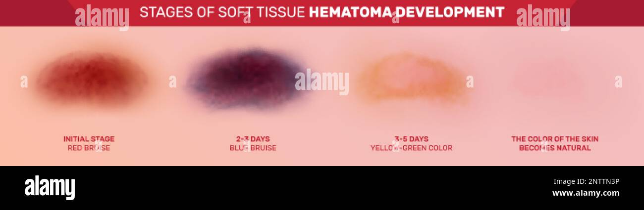 Scares injures seams realistic set with isolated images of bruise ...