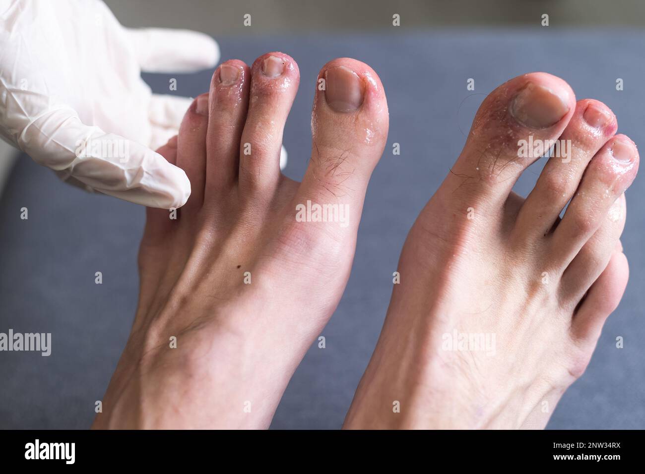 A man's toes showing what looks like a rash with red blotchy skin. A ...