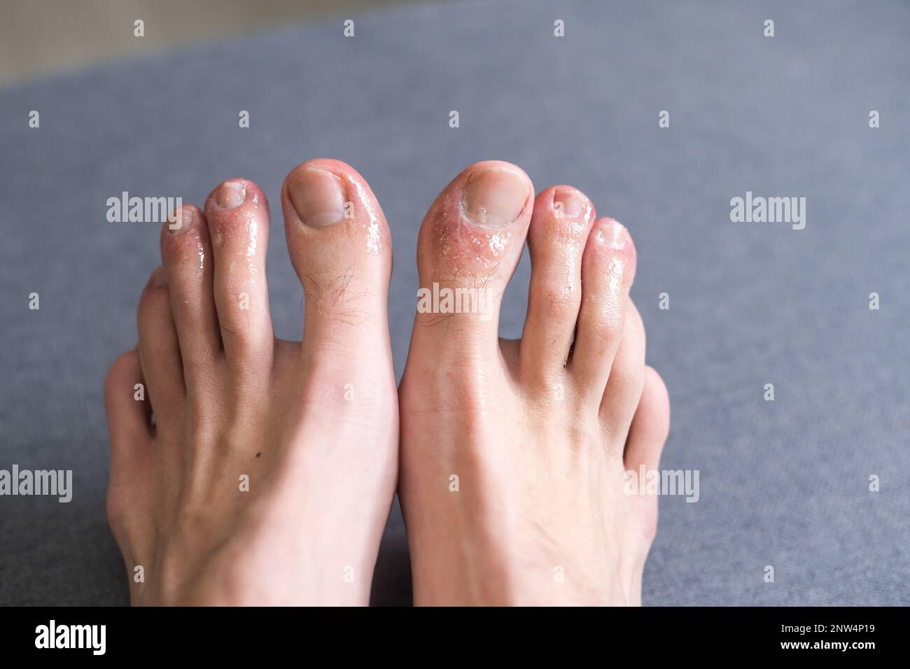 A white man holding his toes, showing what looks like a rash with red ...