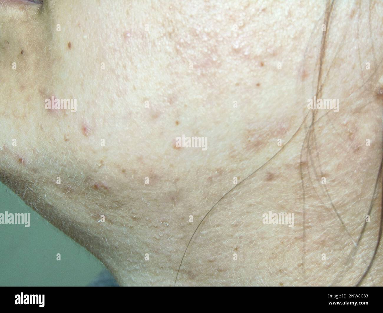 Woman with pimples on her face. Woman with acne skin Stock Photo - Alamy