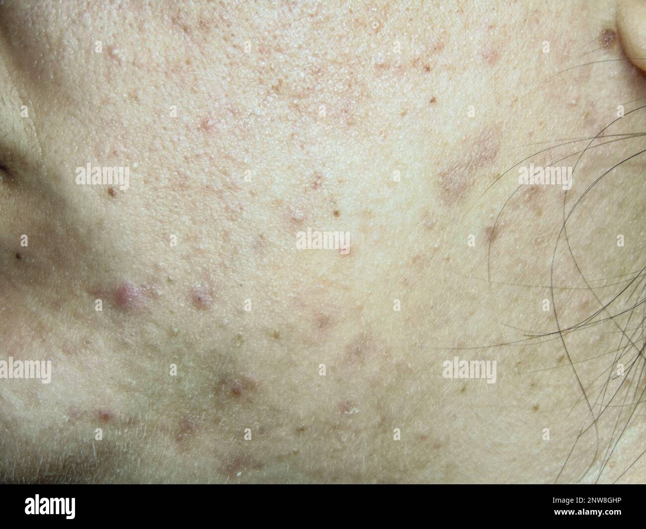Woman with pimples on her face. Woman with acne skin Stock Photo - Alamy