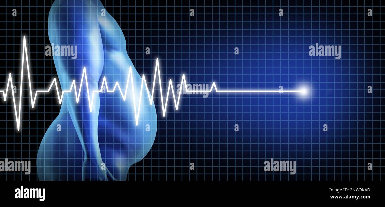 Obesity death risk and premature deaths caused by being overweight as a ...