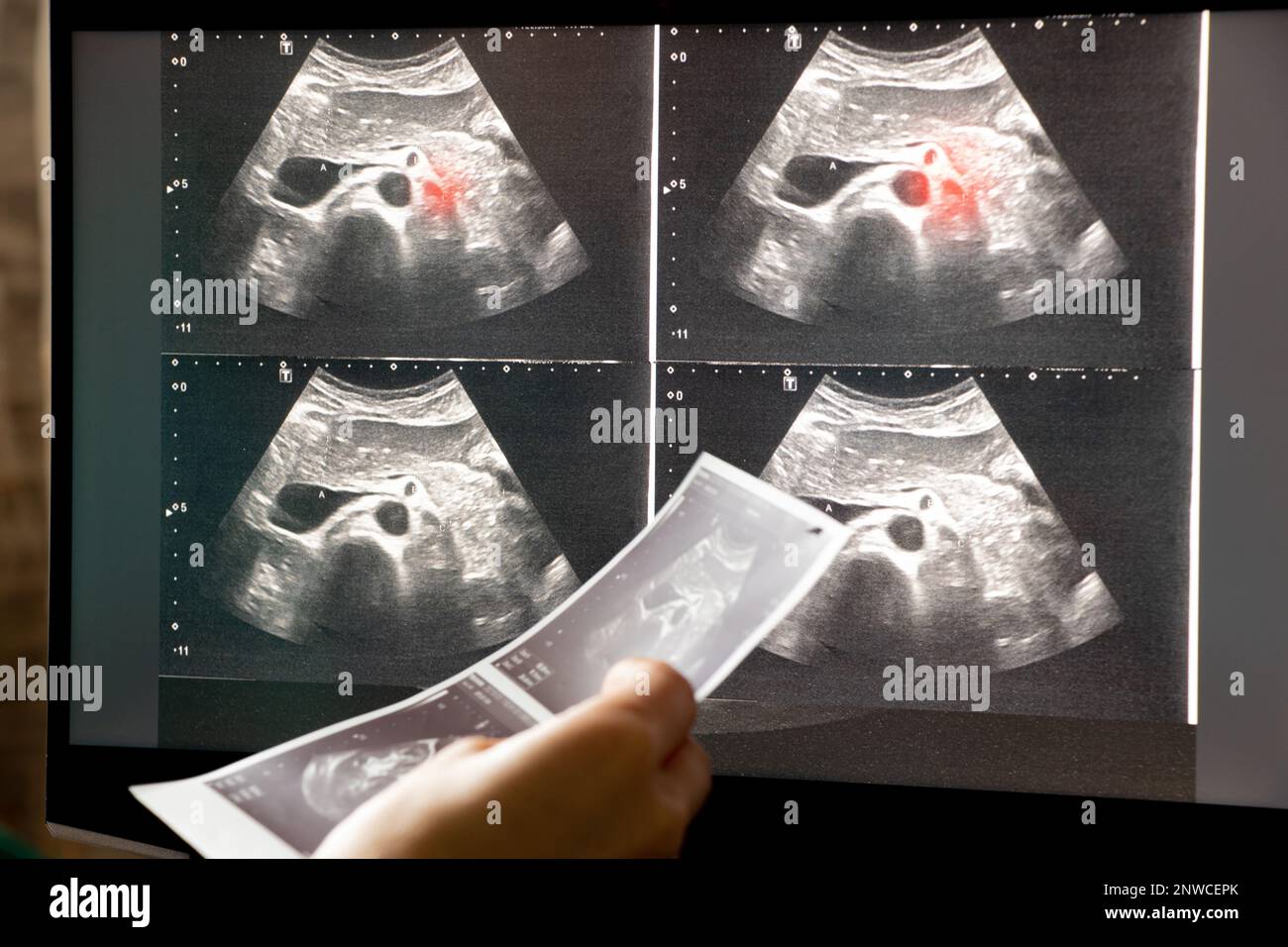 Ultrasound of a woman's abdomen on a laptop screen monitor in a doctor ...