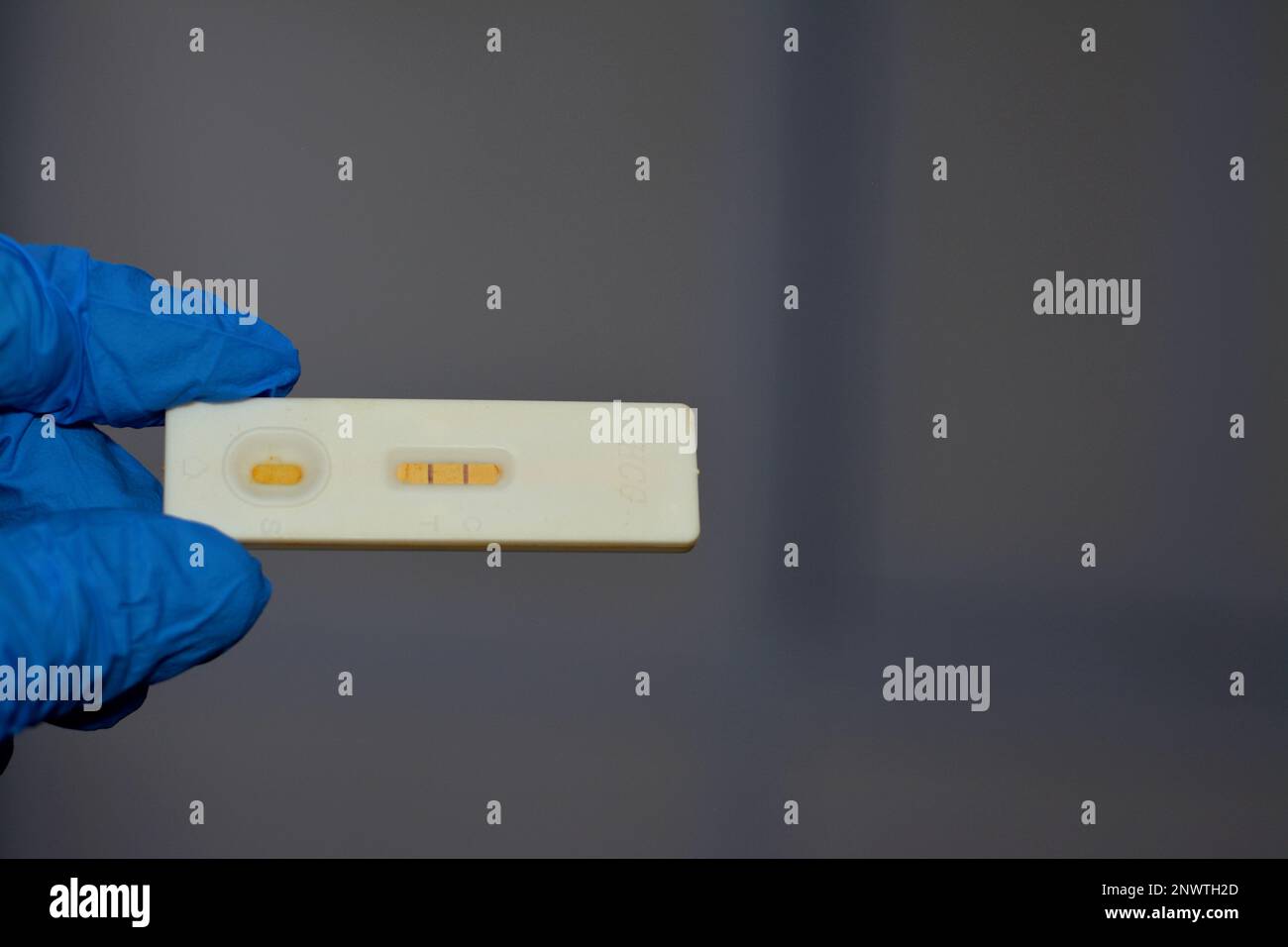 Positive urine pregnancy test, Human chorionic gonadotropin (hCG), a ...