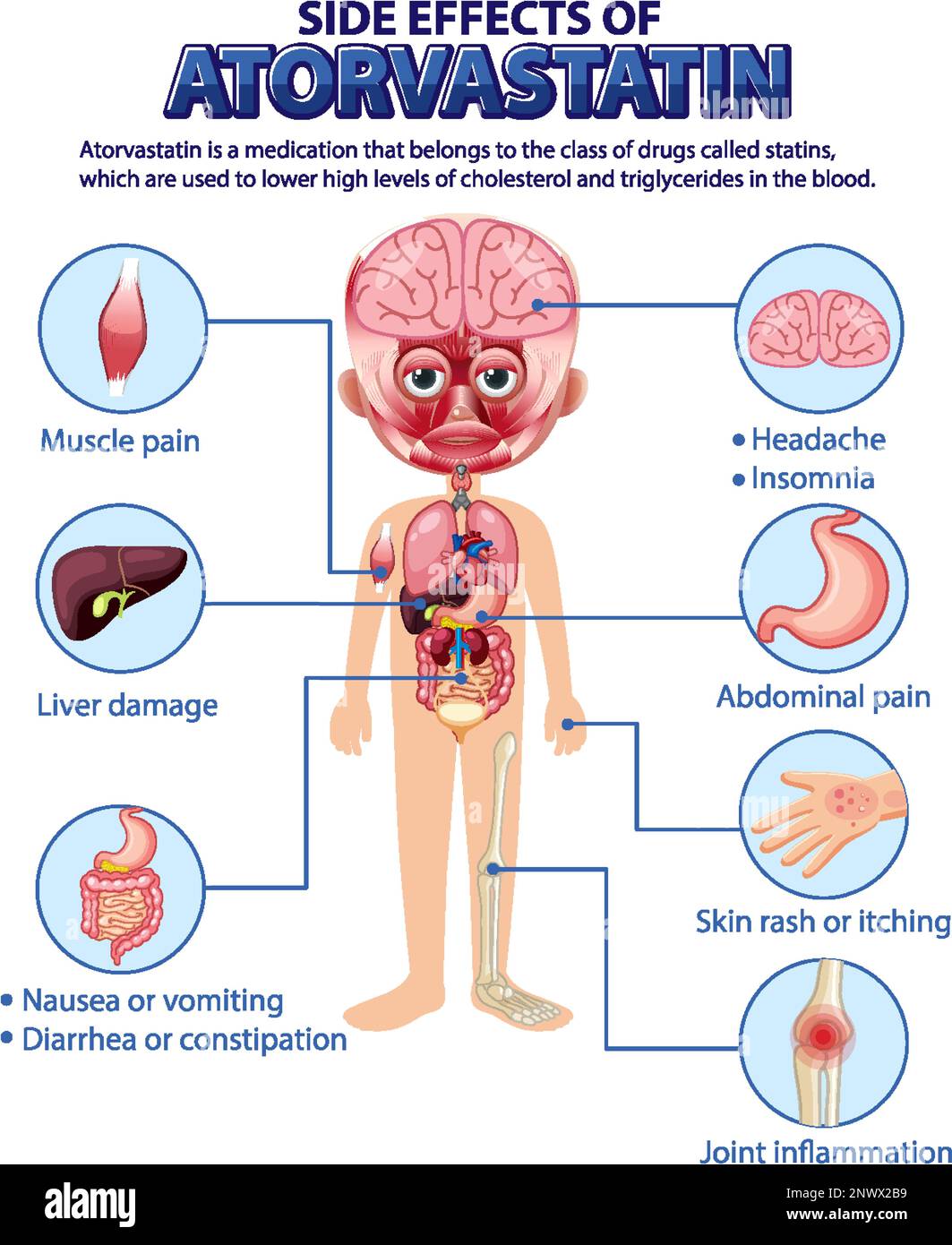 Human anatomy diagram cartoon style of Atorvastatin side effects ...