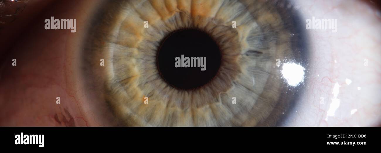 Closeup of red damaged or irritated eye. Eye cornea with red vessels ...