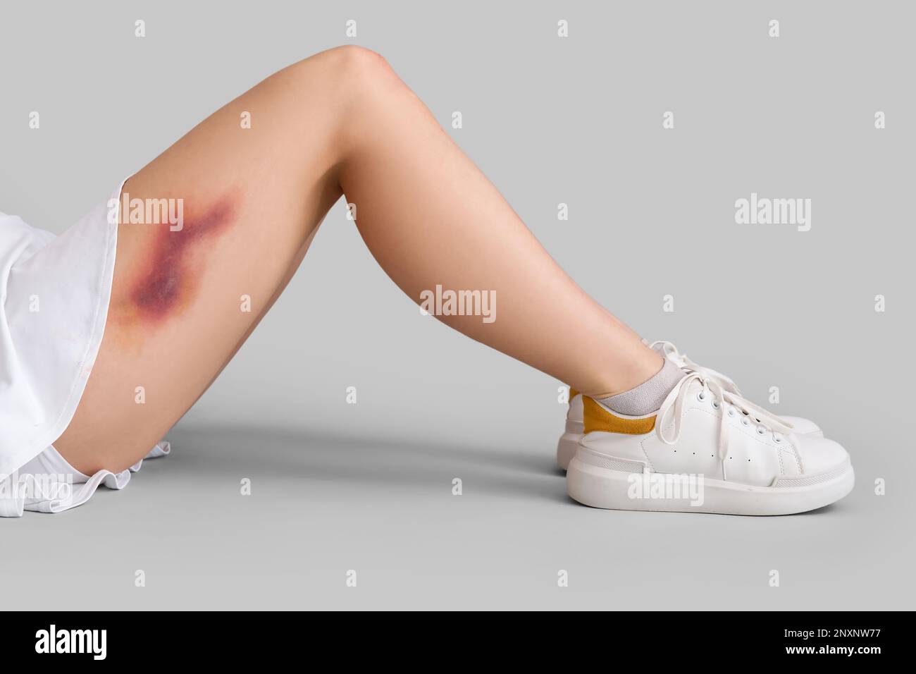 Bruised leg hi-res stock photography and images - Alamy