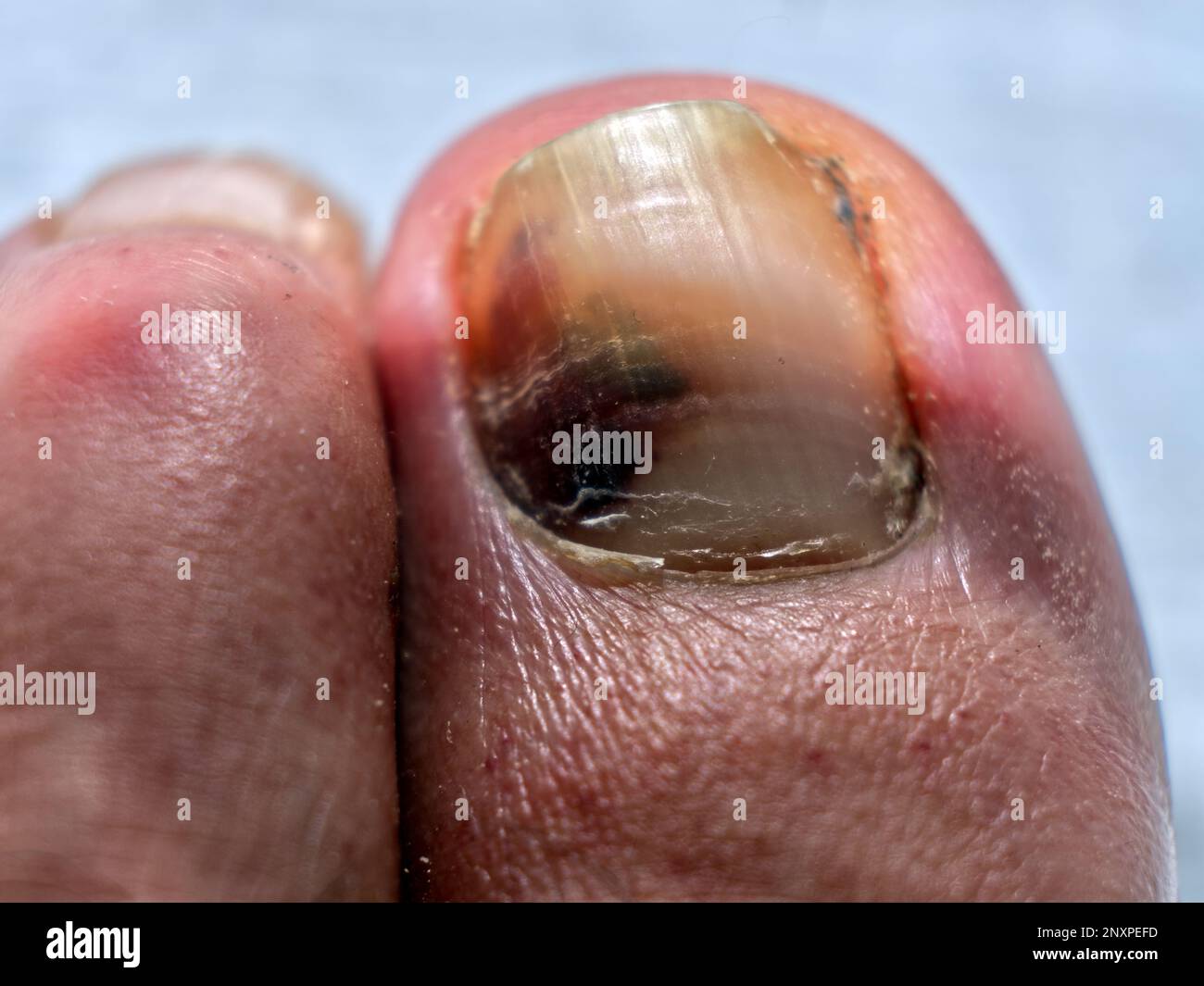 Subungual Hematoma In A Big Toe Stock Photo Alamy subungual-hematoma-in-a-big-toe-stock-photo-alamy