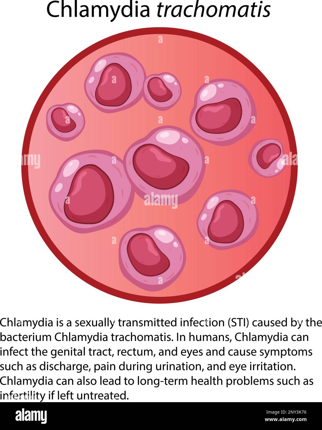 Chlamydia trachomatis with explanation illustration Stock Vector Image ...
