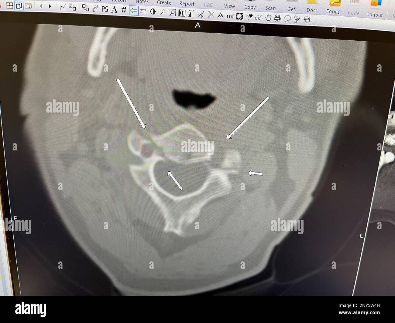 A photo of the CAT Scan shows where Fort Knox EM R.J. Dyrdek broke his ...