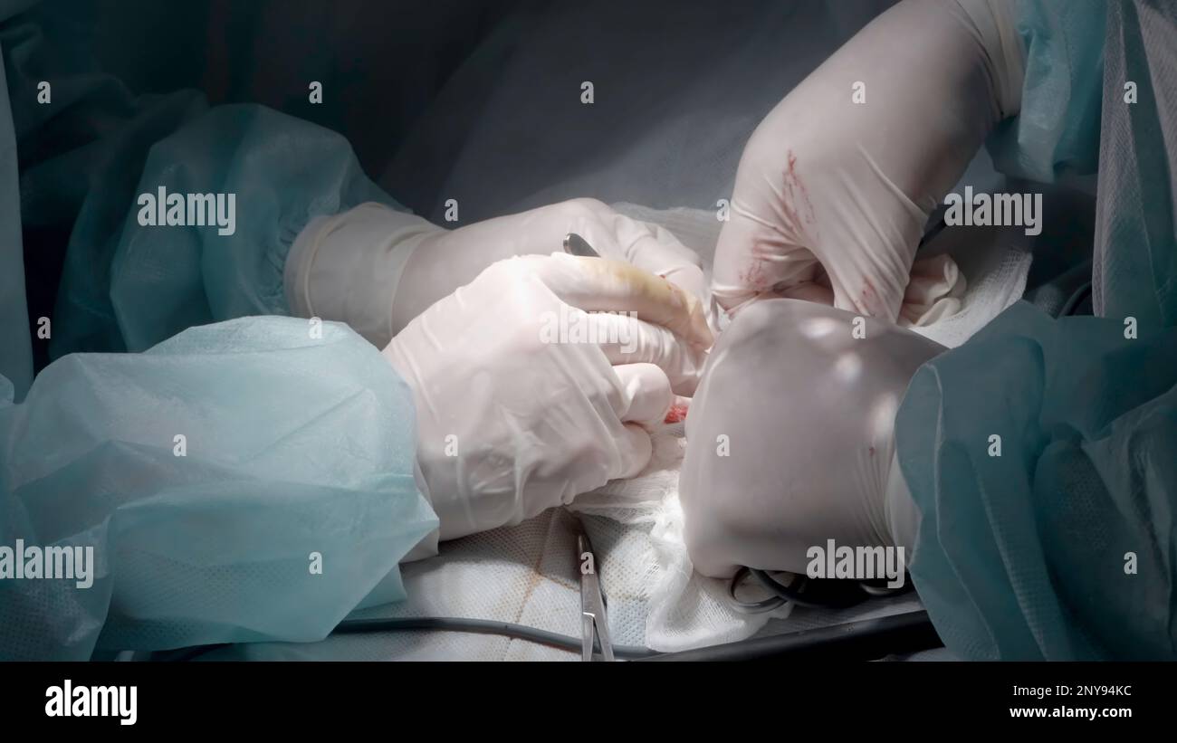 Close-up of surgeons' hands during surgery. Action. Surgeon's hands ...