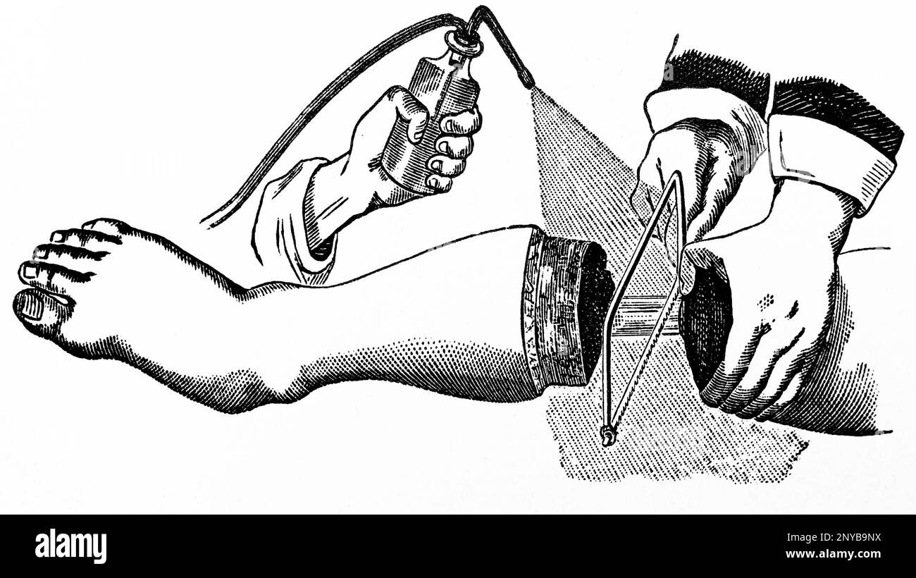 Civil War Amputation Process