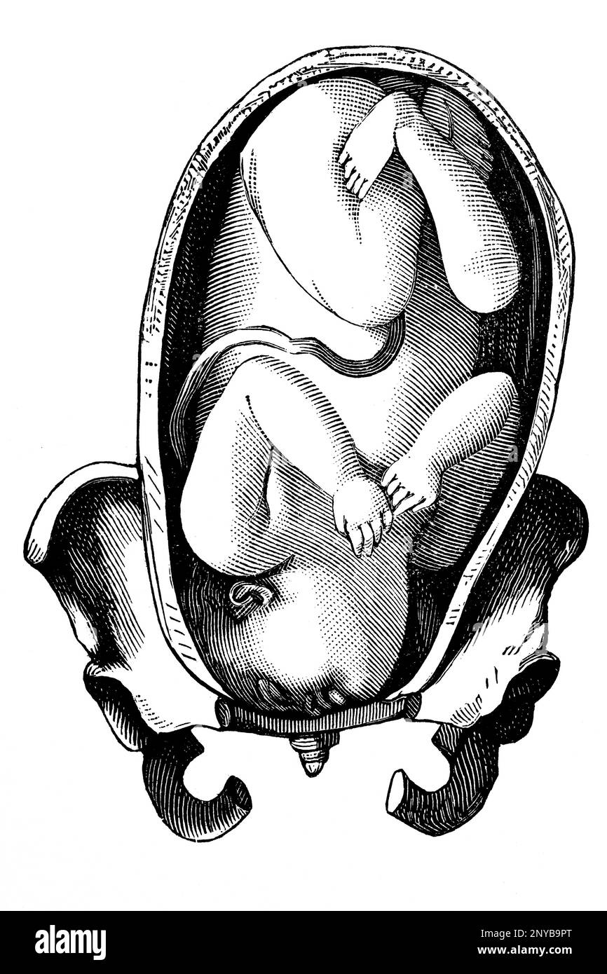 Abnormal position of the fetus. Face presentation. Antique illustration ...