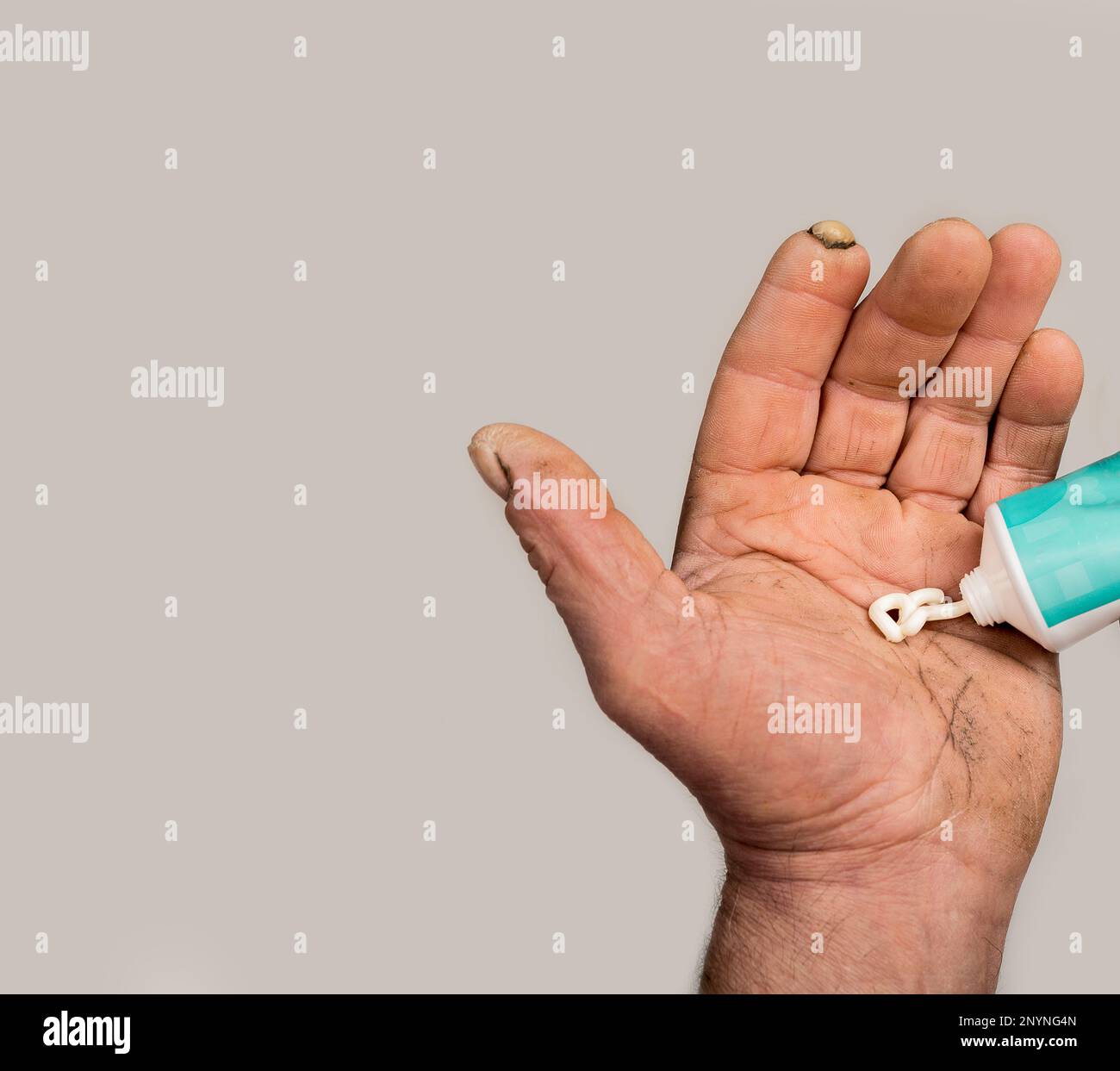 Cut tip of the finger. Overworked hand with a cream Stock Photo - Alamy