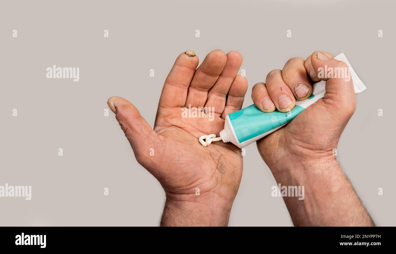 Male overworked cracked hands with a cream Stock Photo - Alamy