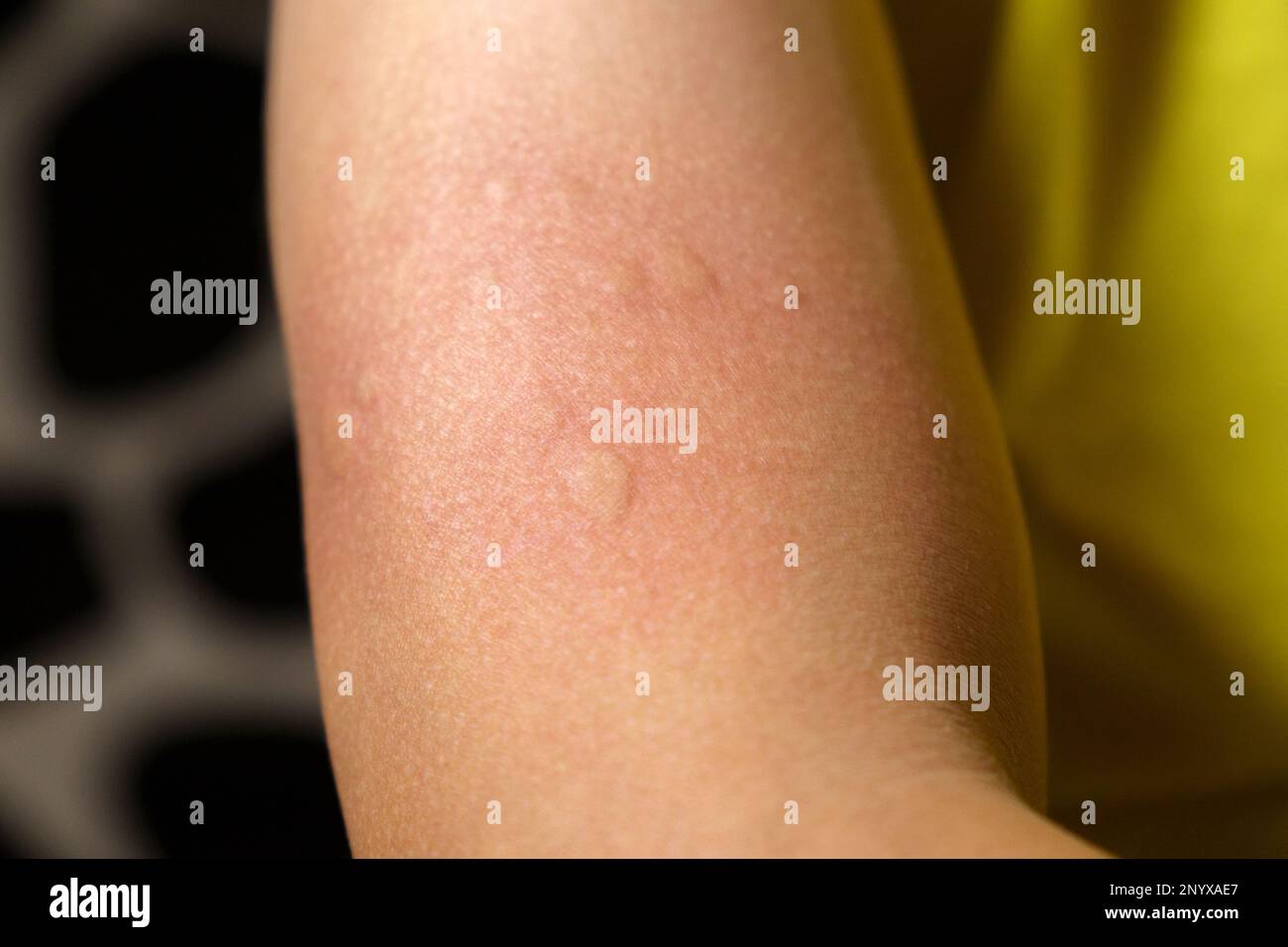 Allergy skin test injection hi-res stock photography and images - Alamy
