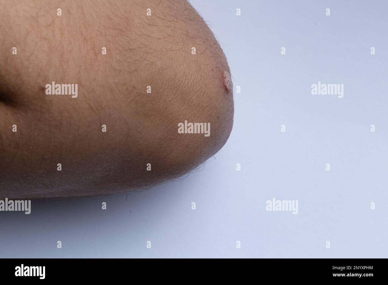 Teenage Boy with Wart on Arm: Causes, Treatment, and Prevention Stock ...