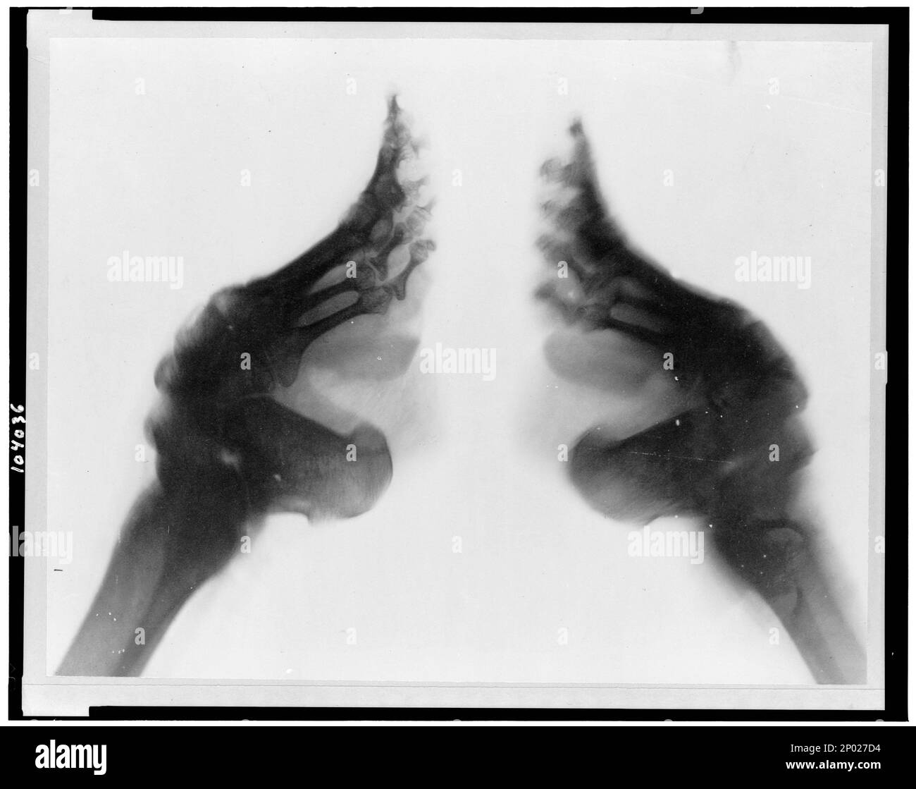 X-ray of bound feet, China. Frank and Frances Carpenter Collection ...